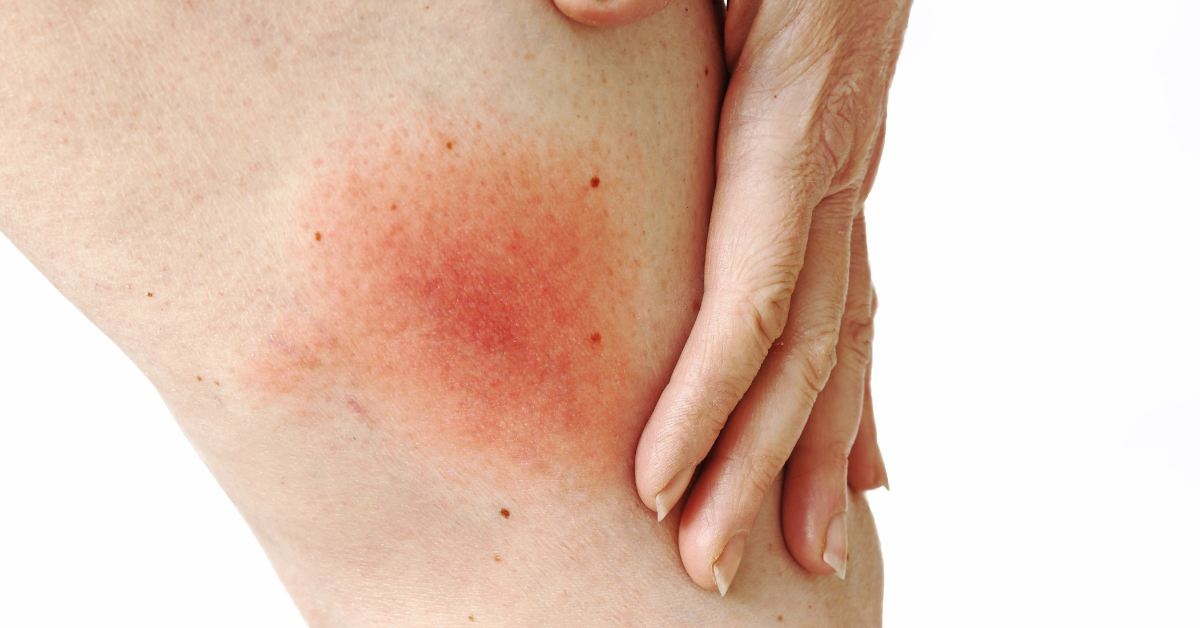 Lyme Disease | Medical Offices of Manhattan